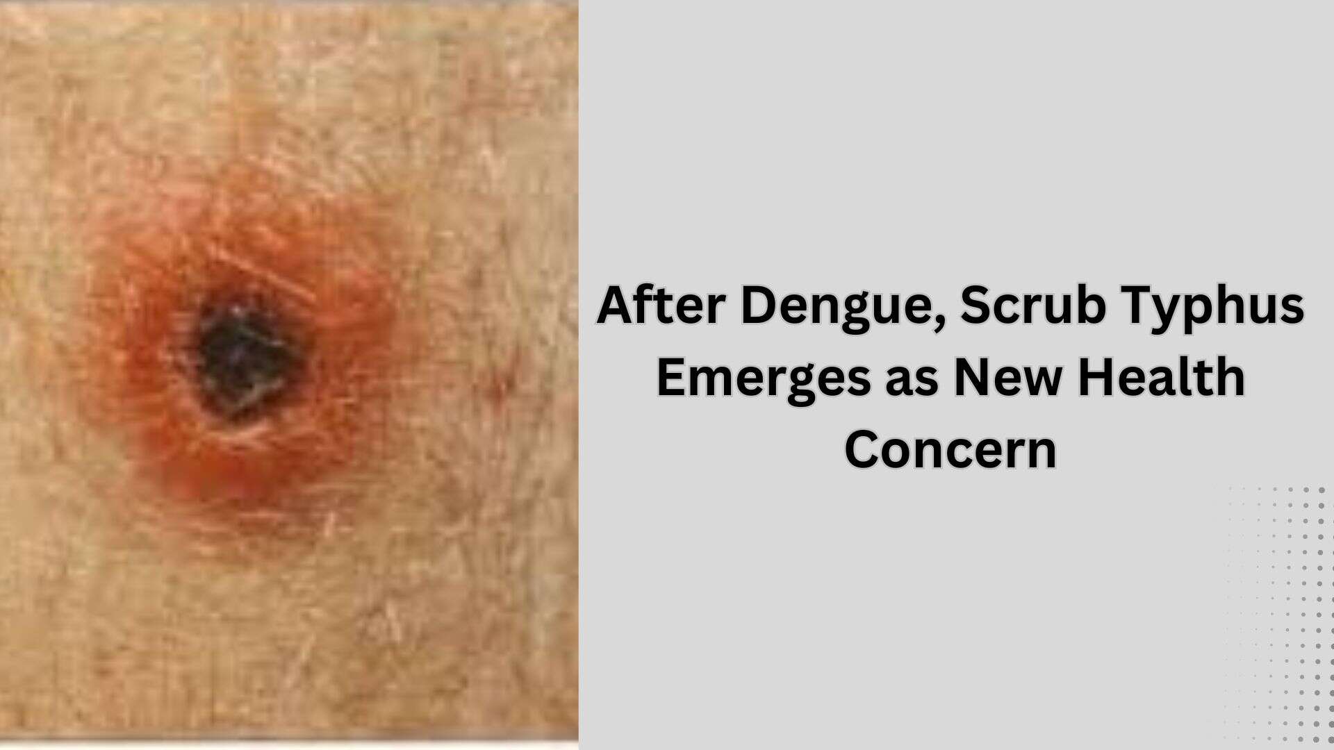 Scrub Typhus Emerges as New Health Concern in Udaipur