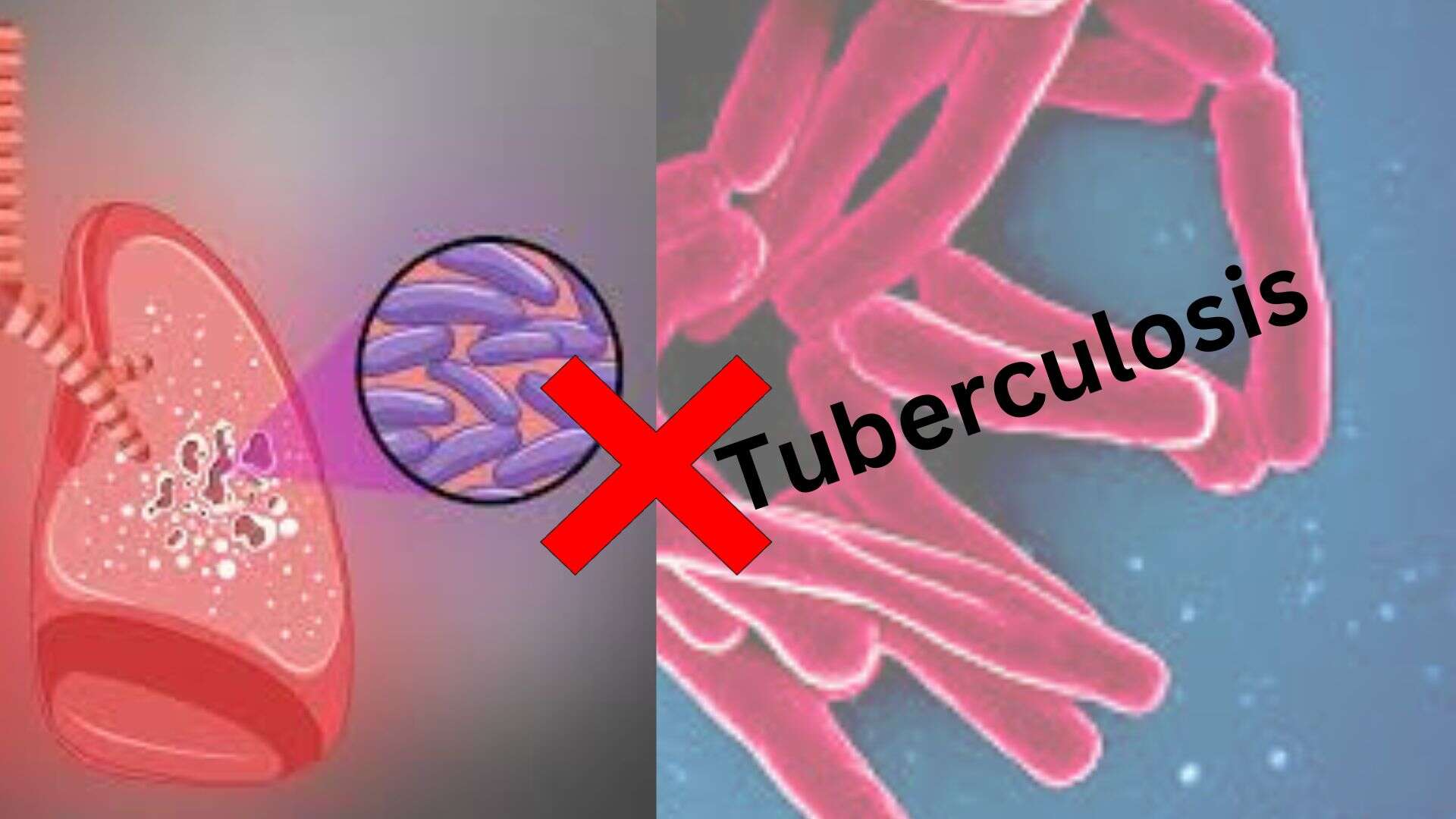 Nikshay Poshan Yojana: Financial Support for TB Patients Increased